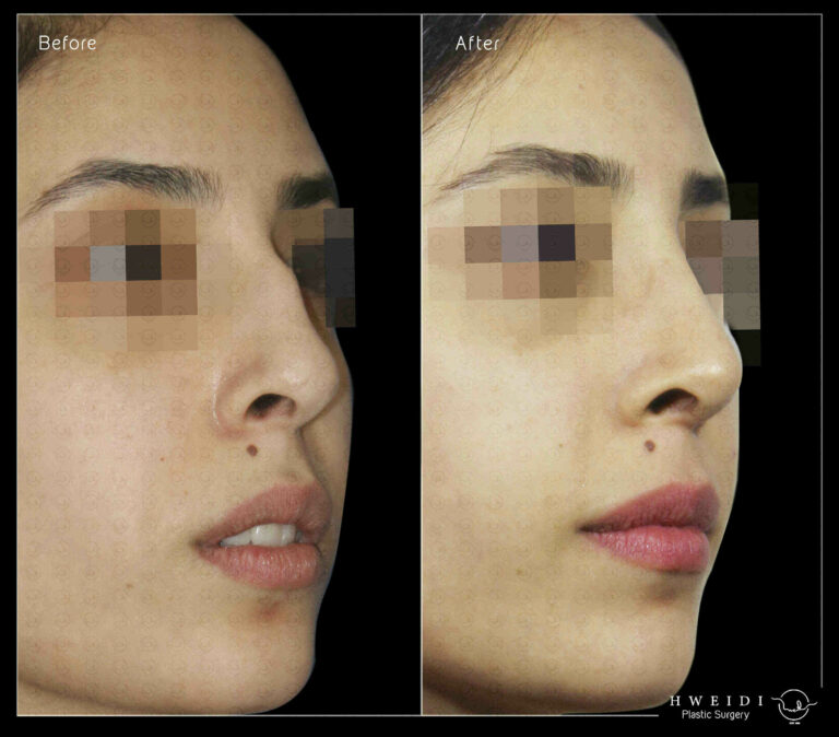 جراحة تجميل وتصغير الأنف دكتور أحمد صبحى هويدى إستشارى جراحات التجميل والترميم